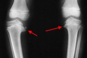Blount’s Disease