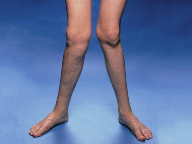 Knock Knees - Orthopaedia